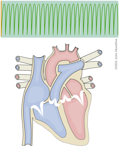 Atrioventricular block bradycardia – Heart Explained